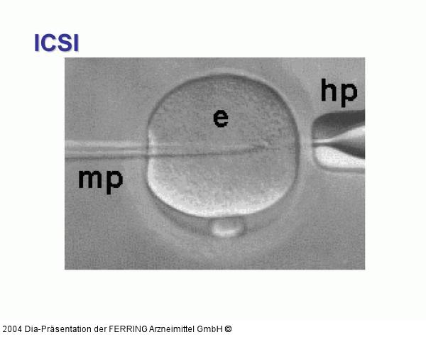 Abbildung 1: In-vitro-Fertilisation - ICSI