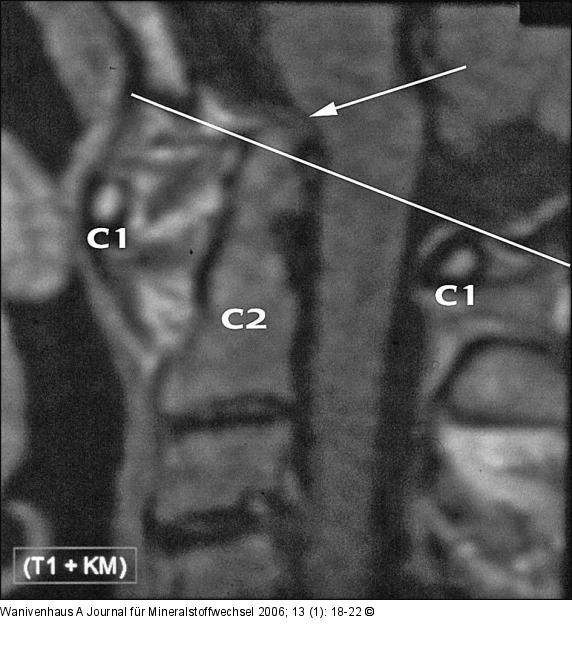 Abbildung 3: Myelon - Densspitze