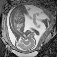 Abbildungen und Graphiken: Pränatale Magnetresonanztomographie