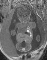 Abbildungen und Graphiken: Pränatale Magnetresonanztomographie